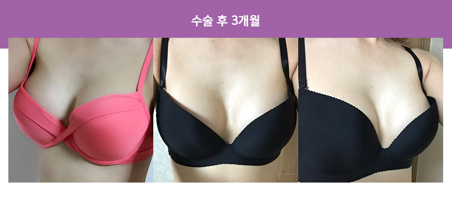 32c Implants